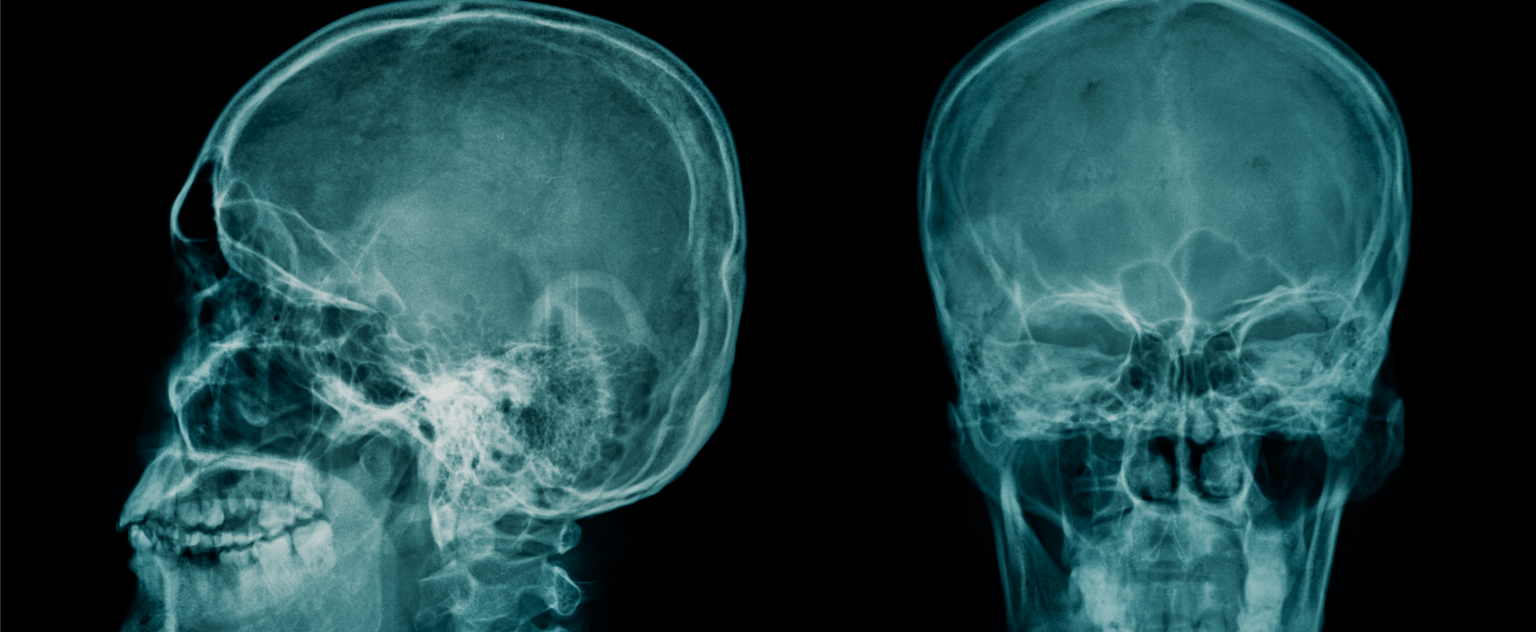 The Thin Skull Rule And The Crumbling Skull Rule What Are They James H Brown And Associates